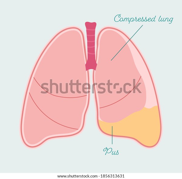 Pleural empyema - anatomical scheme in hand drawn style. Gathering of ...