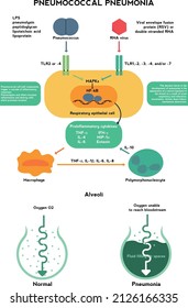 Pneumococcal pneumonia : 383 images, photos et images vectorielles de ...