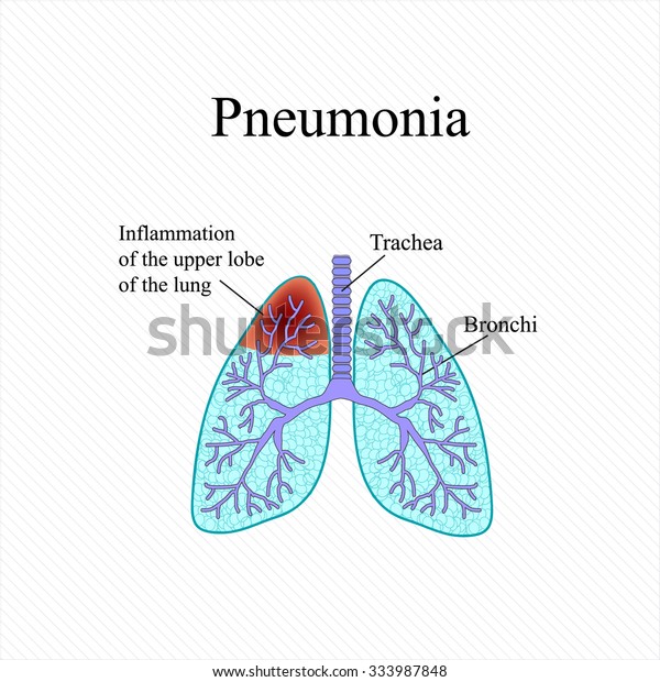 Pneumonia Anatomical Structure Human Lung Inflammation 스톡 벡터(로열티 프리 ...