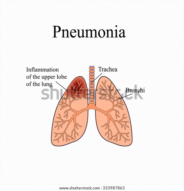 Pneumonia. The anatomical structure of the human lung. Inflammation of the upper lobe of the ...