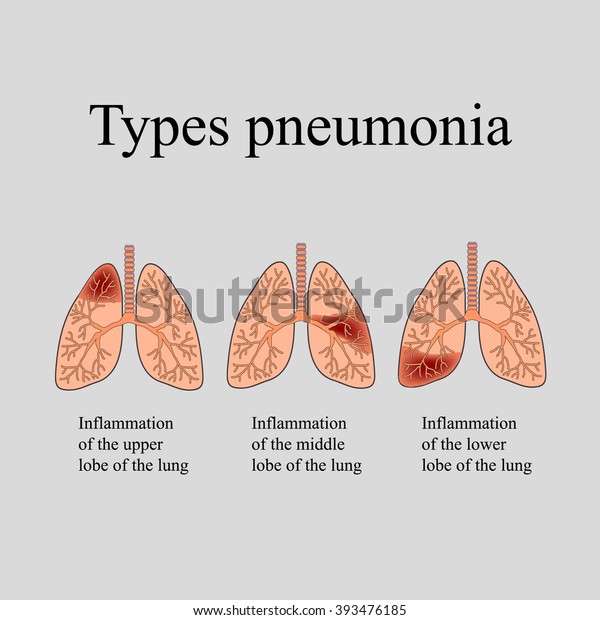 Pneumonia Anatomical Structure Human Lung Type Lagervektor (royaltyfri ...