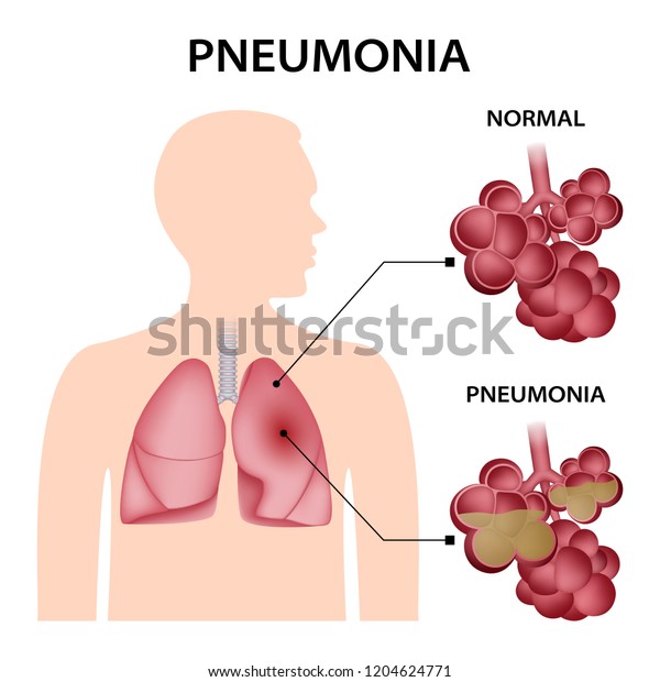 Pneumonia Concept Background Realistic Illustration Pneumonia Stock ... Pneumonia Concept Background Realistic Illustration Pneumonia Stock ...