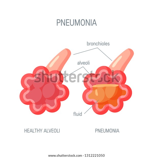 Pneumonia Disease Concept Vector Illustration Flat Stock Vector ...