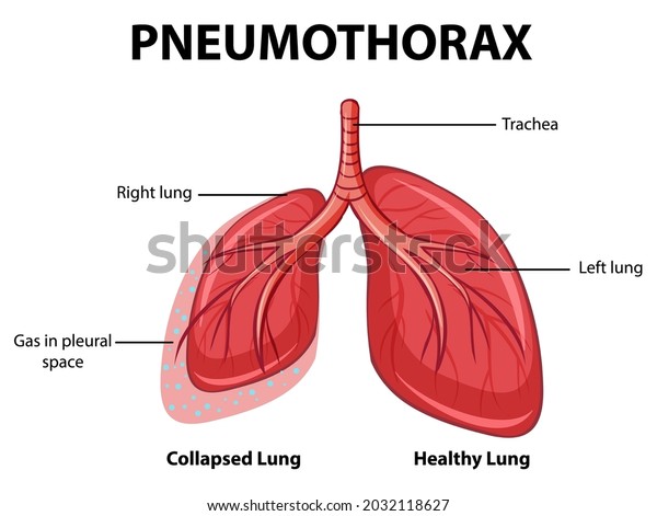 Pneumothorax Diagram Collapsed Lung Healthy Lung Stock Vector (Royalty ...