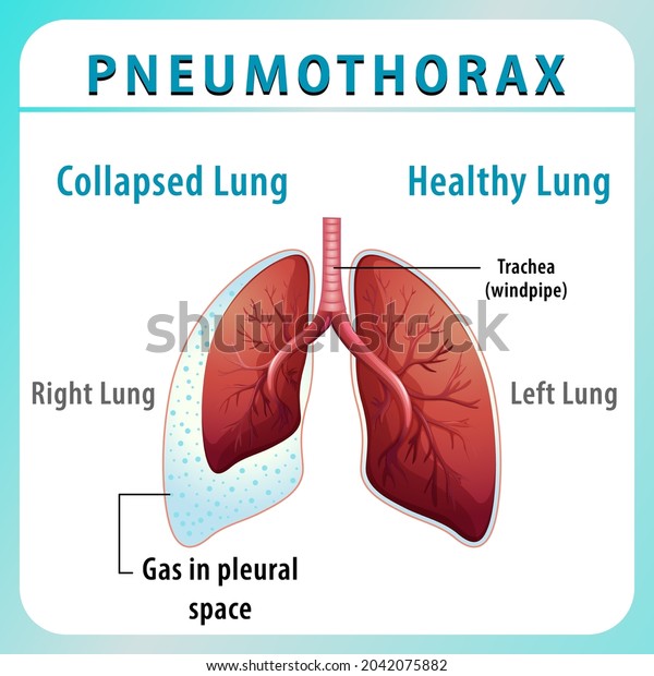 Diagrama de neumotórax con pulmón colapsado e ilustración de pulmón sano
