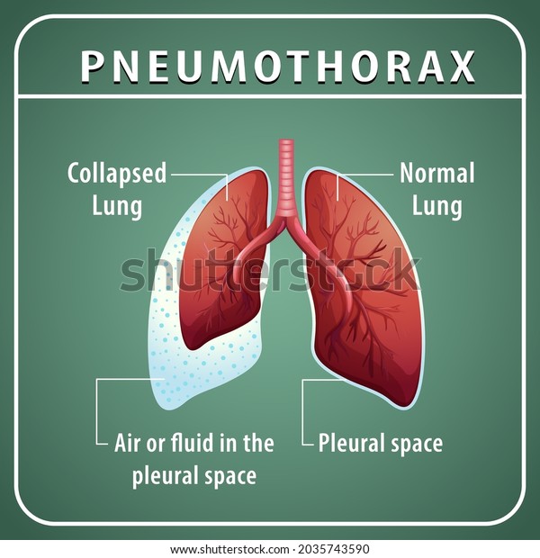 Pneumothorax Diagram Collapsed Lung Normal Lung Stock Vector (Royalty ...