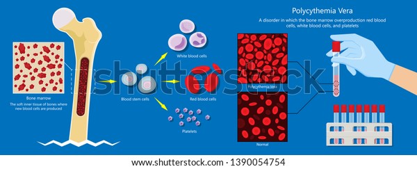 Polycythemia Vera Pv Blood Clots Cancer Stock Vector (Royalty Free ...