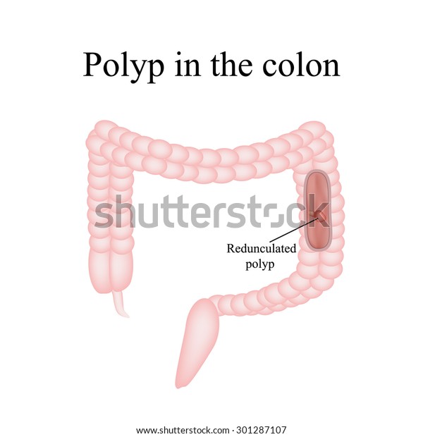 Polyp in the intestine. Polyp in the colon. Vector illustration on ...