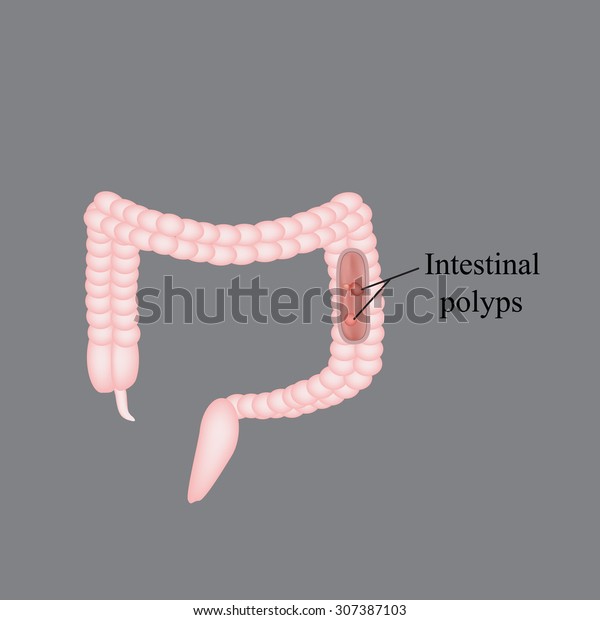 Polyp Intestine Polyp Colon Vector Illustration Stock Vector (Royalty ...