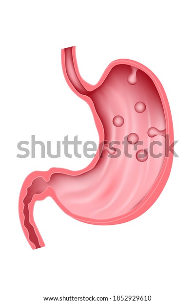 Polyp Stomach Pathology Digestive System Vector Stock Vector (Royalty ...