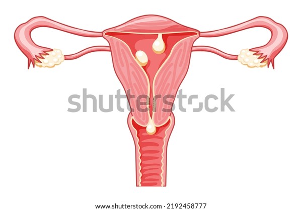 Polyps Uterus Cervical Pedunculated Sessile Female Stock Vector (Royalty Free) 2192458777 ...