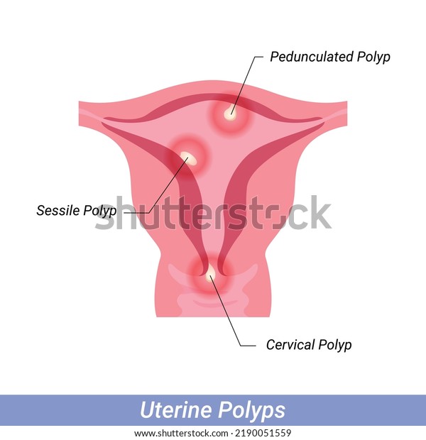 Polyps Uterus Female Reproductive System Human Stock-vektor (royaltyfri) 2190051559 | Shutterstock