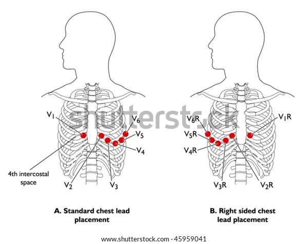 Position Ecg Chest Leads Labeled: เวกเตอร์สต็อก (ปลอดค่าลิขสิทธิ์ ...