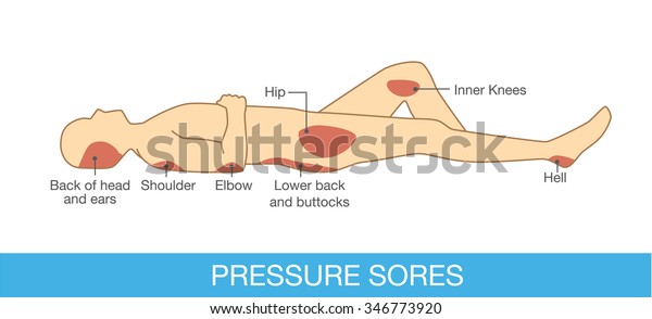 11,336 Pressure sore 图片、库存照片和矢量图 | Shutterstock