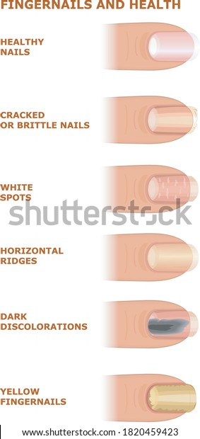 Problems Nails Fingertips Nail Health Types Stock Vector (Royalty Free ...