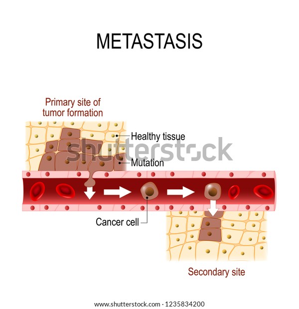 Main Steps In Tumor Progression And Metastasis Cellular Transformation