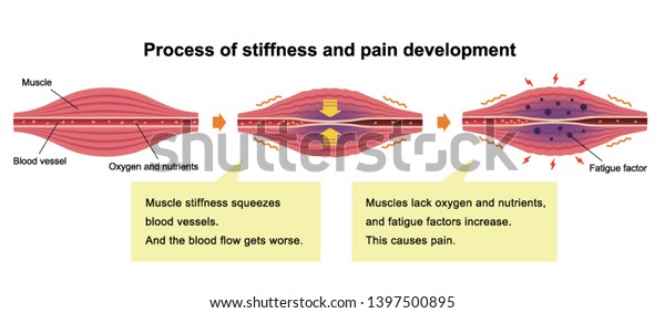 Process Muscles Stiffness Pain Illustration Explanation Stock Vector ...
