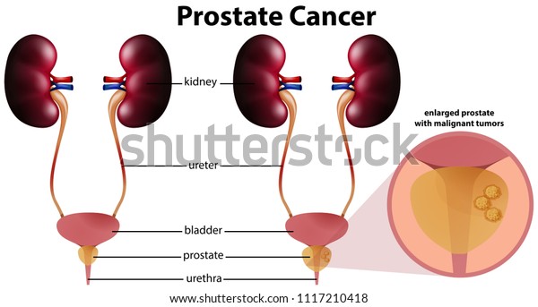Prostate Cancer On White Background Illustration Stock Vector (Royalty ...