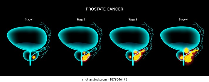 Prostate Cancer Stages Vector Poster Pain Stock Vector (Royalty Free ...
