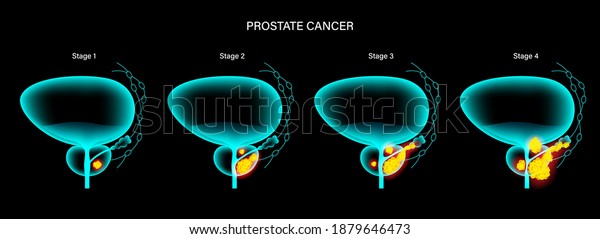 Prostate Cancer Stages Vector Poster Pain Stock Vector (Royalty Free ...