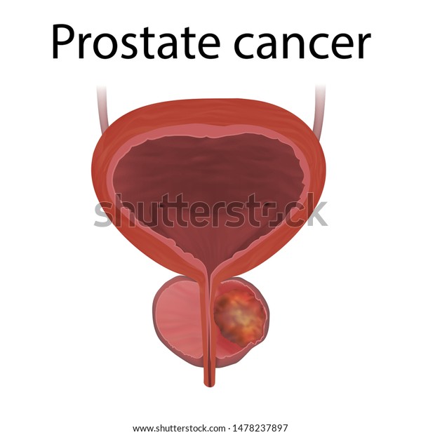 Prostate Cancer Tumor Realistic Vector Medical Stock Vector (Royalty ...