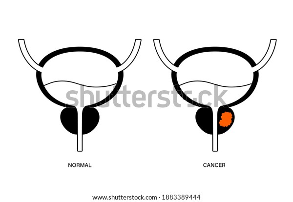 Prostate Cancer Vector Logo Clinic Normal Stock Vector (Royalty Free ...