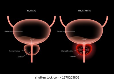Prostatitis Swelling Inflammation Prostate Gland Normal Stock Vector ...