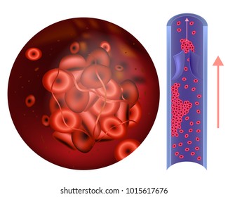 Hypercoagulation Images, Stock Photos & Vectors | Shutterstock