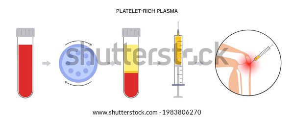 Prp Therapy Knee Disease Separation Erythrocytes Stock Vector (Royalty ...
