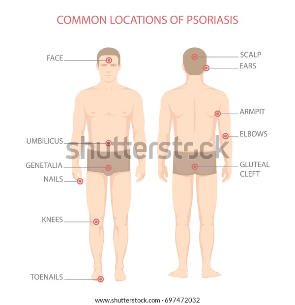 Psoriasis Illness Diagram Human Body Skin Disease