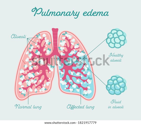 Pulmonary Edema Anatomical Scheme Hand Drawn: Vector có sẵn (miễn phí ...