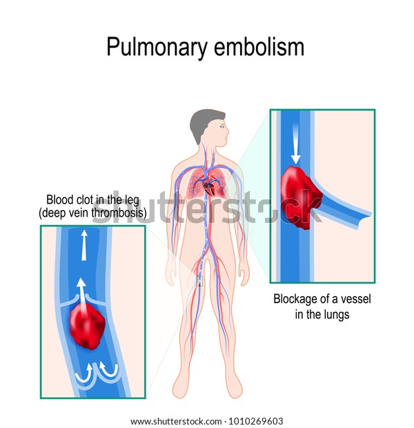 Pulmonary embolism. Human silhouette with highlighted circulatory ...