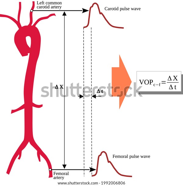 Pulse Wave Velocity Pwv Measure Arterial Stock Vector (Royalty Free ...
