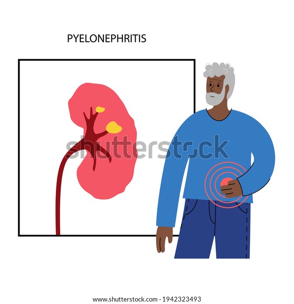 Pyelonephritis in human kidney. Urinary system disease isolated flat ...