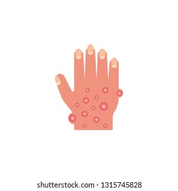 Urticaria Icon Skin Rash Hives Color Stock Vector (Royalty Free) 2129320442