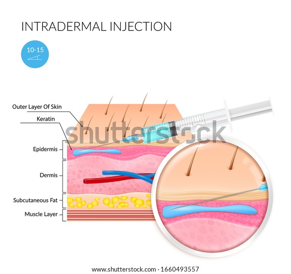 Realistic Image Intradermal Injection On White Stock Vector (Royalty ...