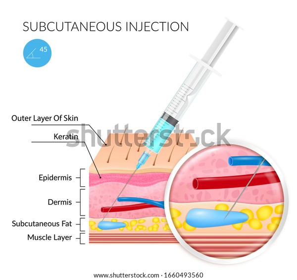 Subcutaneous Layer Diagram