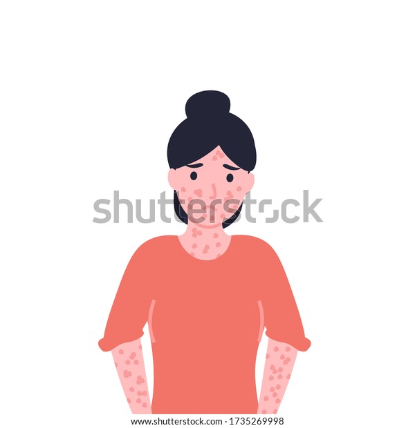Red Rash All Over Body Flat: เวกเตอร์สต็อก (ปลอดค่าลิขสิทธิ์ ...