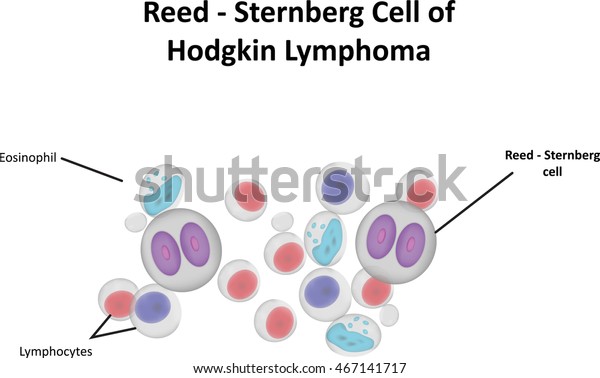 Reed Sternberg Cell Stock Vector (Royalty Free) 467141717
