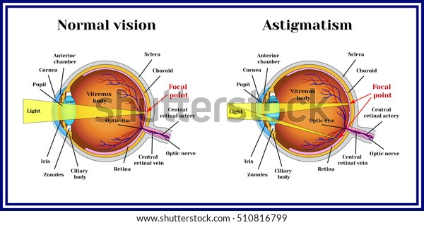 Refractive Errors Eyeball Astigmatism Stock Vector (Royalty Free) 510816799 Refractive Errors Eyeball Astigmatism Stock Vector (Royalty Free) 510816799