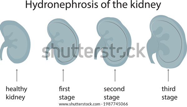 Renal hydronephrosis is a progressive,stages of the disease, persistent ...