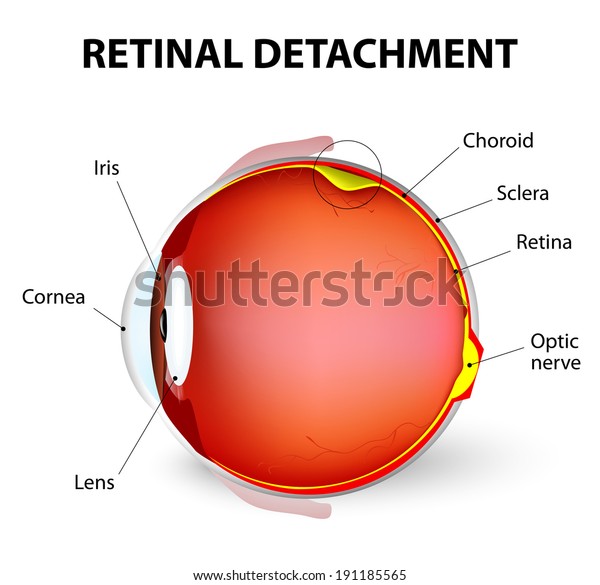 Retinal Detachment Eye Disease Which Part Stock Vector (Royalty Free ...