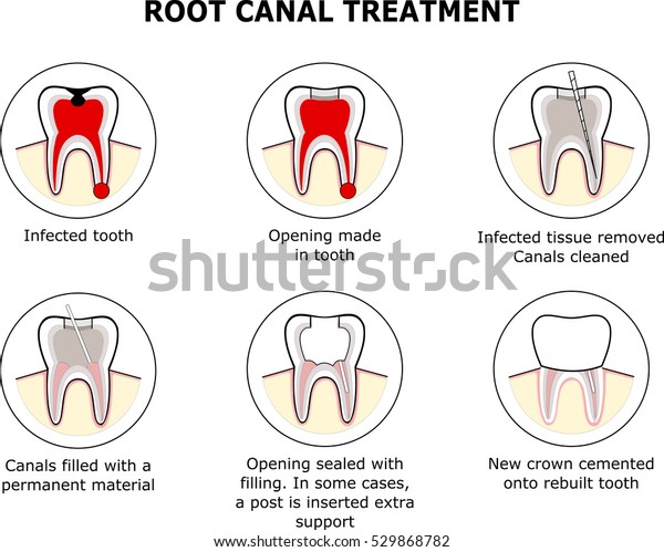 Root Canal Treatment Vector Illustration Stock Vector (Royalty Free ...