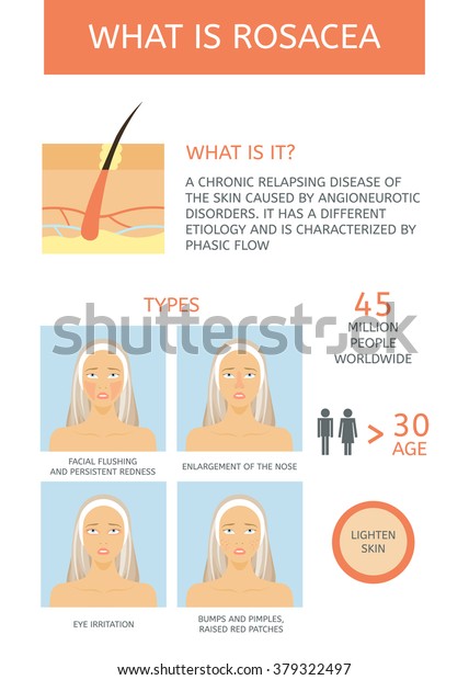 Rosacea Causes Types Facts Infographics Stock Vector (Royalty Free ...