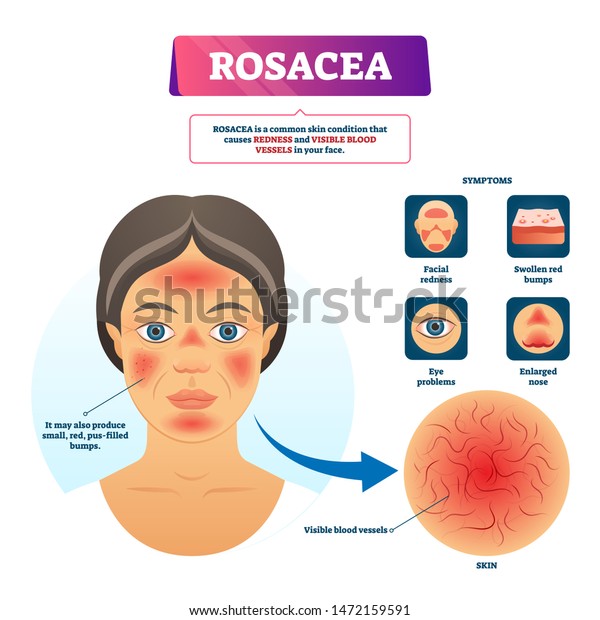 Rosacea vector illustration. Labeled red skin problem explanation ...