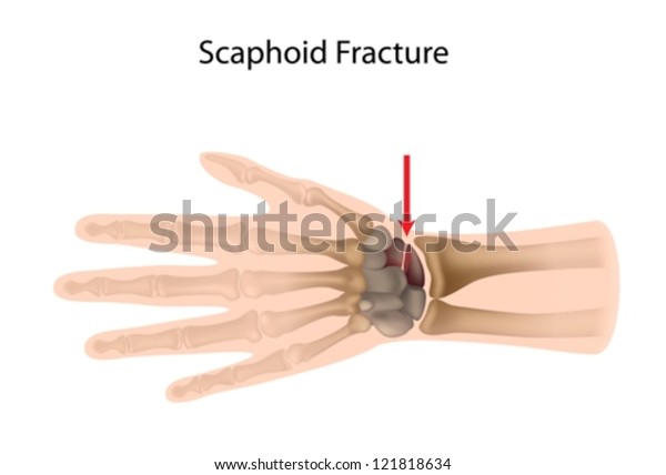 Scaphoid Wrist Fracture Stock Vector (Royalty Free) 121818634 ...