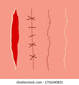 9,484 Surgical Incision Images, Stock Photos & Vectors | Shutterstock