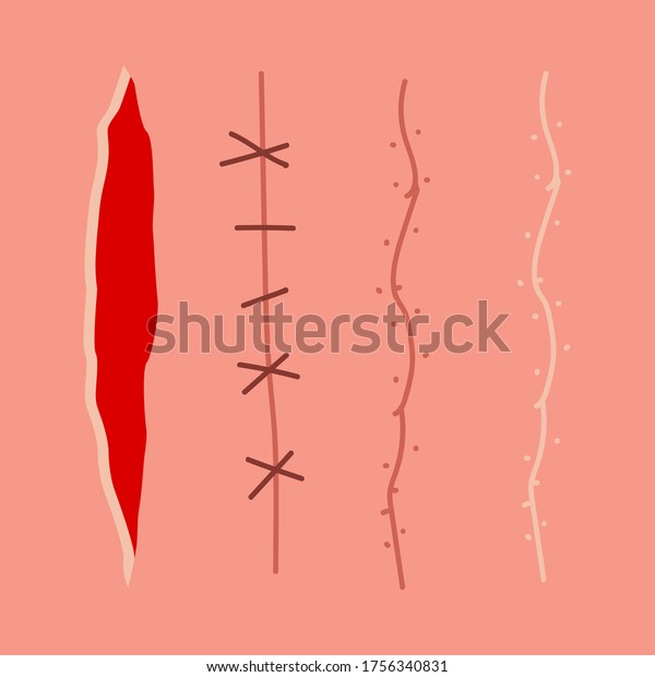Scar, wound, incision, suture vector set isolated on background.
