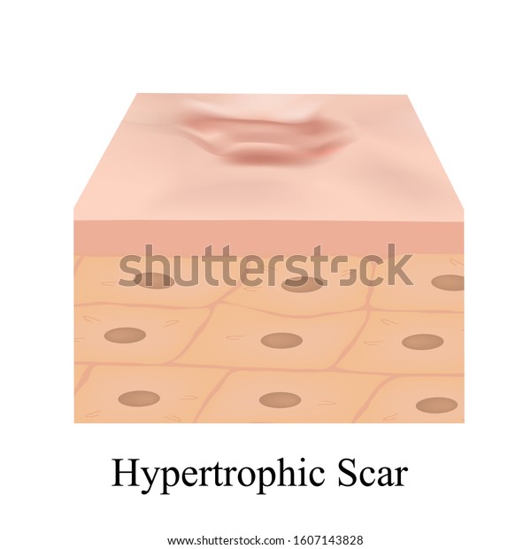 Scars Hypertrophic Anatomical Structure Skin Scar 库存矢量图（免版税）1607143828 ...