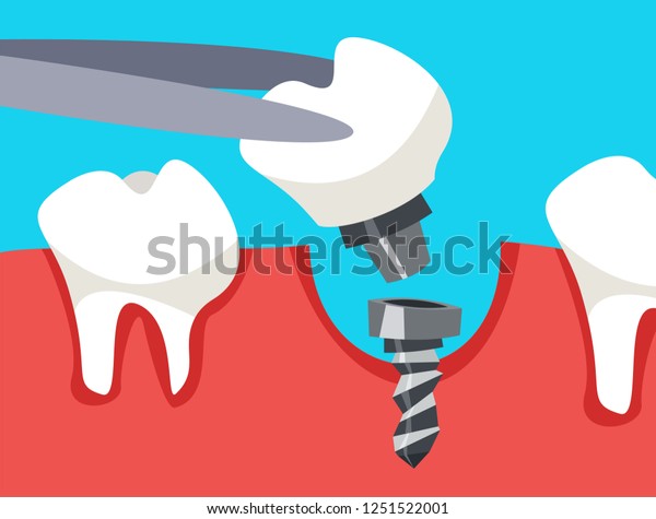 Información gráfica esquemática de dientes humanos: vector de stock ...